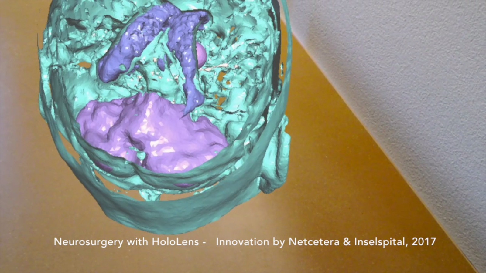 Hololens in neurosurgery - Successful prototype with the University ...